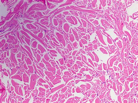 Pathology Outlines Case Of The Week 469
