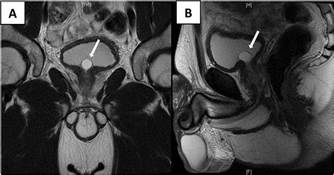 Coronal A And Sagittal B Pelvic Male Mri Images Showing A