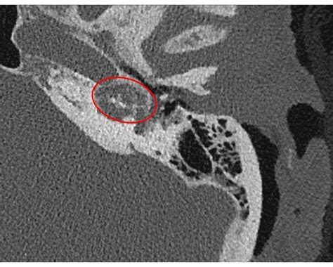 Robotic Cochlear Implantation For Direct Cochlear Access