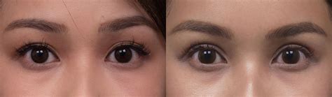Before And After Asian Blepharoplasty Gallery Taban Md 54 Off