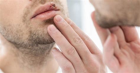 Genital Herpes Men Signs