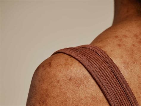 The Common Causes Of Bacne—and How To Address It Hair Lux Shop