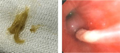 Left Cast Bronchitis Right Mucus Loosed After Instillation Of Download Scientific Diagram