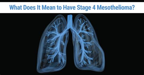Stage 4 Mesothelioma How To Treat It And Improve Prognosis