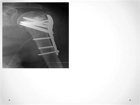 Osteoporotic Bone Fractures Pptx