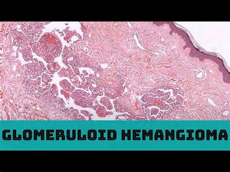 Glomeruloid Hemangioma Leading To A Diagnosis Of Poems Syndrome