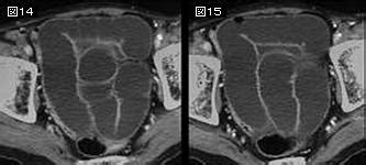 Obstruction Ileus Ile