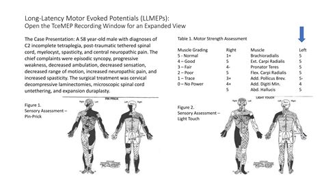 Long Latency Motor Evoked Potentials Llmeps Open The Tcemep