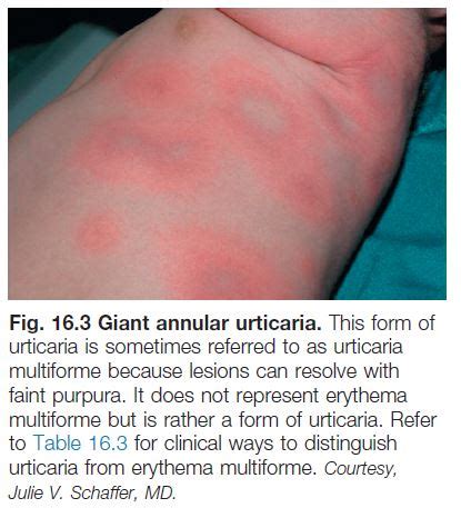Steven Johnson Syndrome Target Lesion