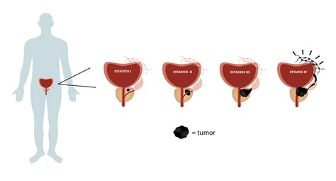 Diagn Stico Y Tratamiento Del C Ncer De Pr Stata Pfizer Espa A