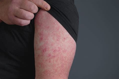 Erysipelas Vs Cellulitis