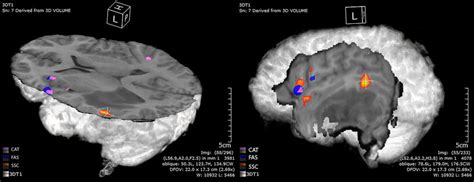 3d reconstruction of fmri activation maps in a patient with left