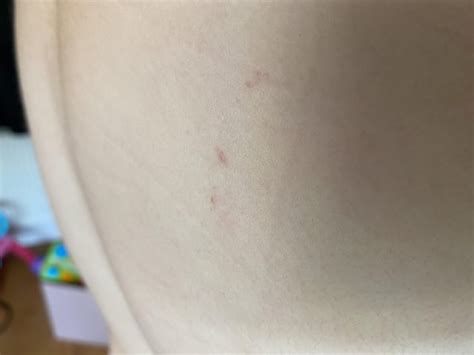 Please Help Is This A Reinfection Or Post Scabies Rscabies