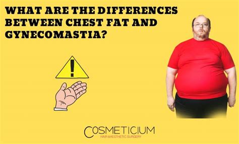 Differences Between Gynecomastia And Chest Fat Cosmeticium