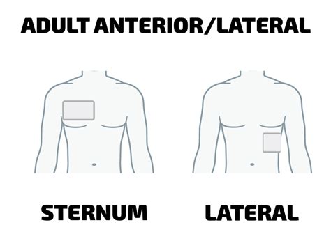 Aed Pad Placement Faq Heartsmart