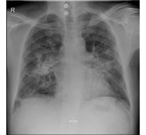 Chest X Ray Showing Worsening Of The Previously Noted Bilateral Patchy