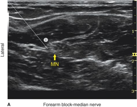 Ultrasound Guided Forearm Blocks Hadzic S Peripheral Nerve Blocks And