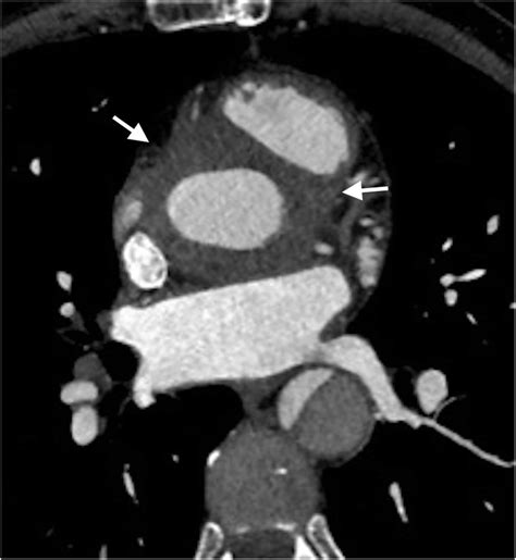 The Usefulness Of Cardiac Ct In The Diagnosis Of Perivalvular