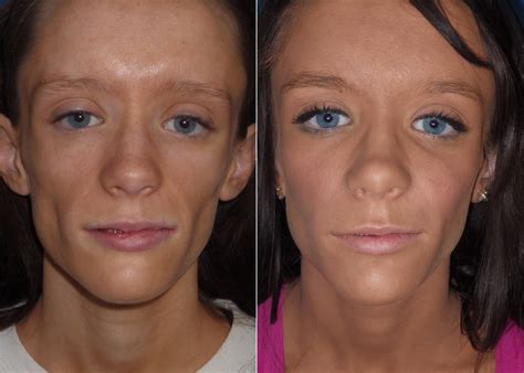 Are Cheek Implants Dangerous At Frank Crawford Blog