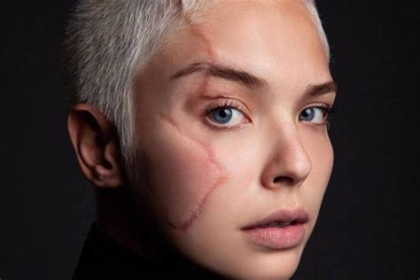Spfw Após Acidente Modelo Inspira Com Cicatriz No Rosto 16112022