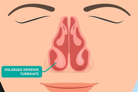Nasal Turbinates Anatomy