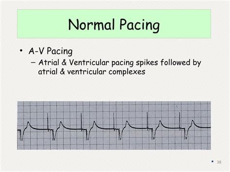 Temporary Pacemaker 2pptx Pptx