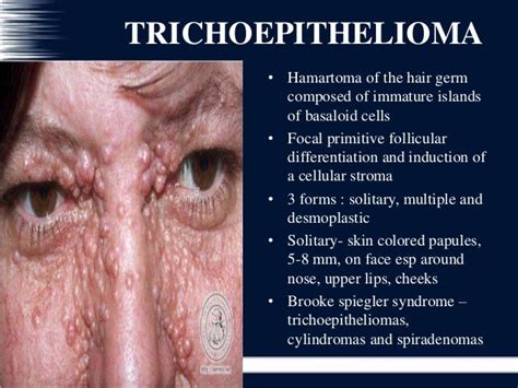 Differentials Of Papules On Face
