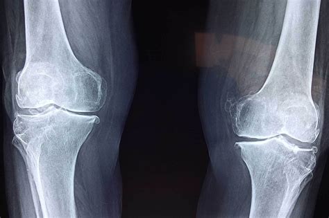 Can Knee Braces Help You Recover From A Torn Meniscus Injury Mcdavid