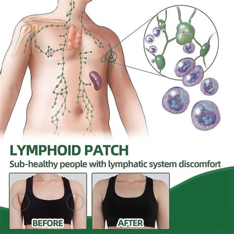 Jaysuing Lymphatic Patch Dredging Collaterals Neck Nodules Groin And