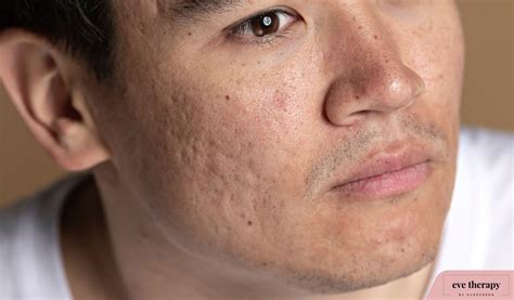 How To Prevent And Treat Acne Scars Eve Therapy