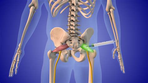 Piriformis Syndrome Why It Feels Like Sciatica