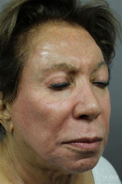 Chemical Peel Before And After Gallery Patient 5