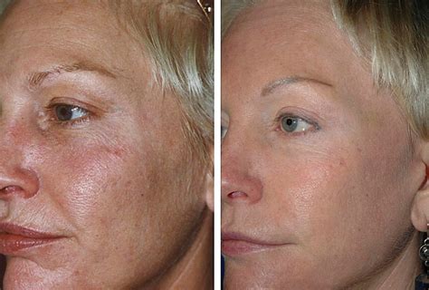 Fractional Skin Resurfacing Laub Dermatology