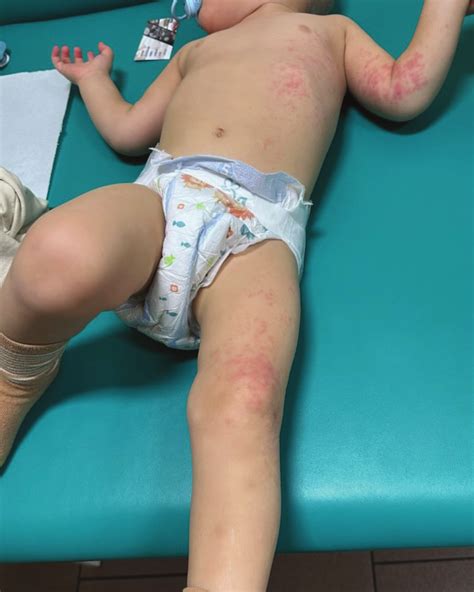 Numerous Erythematous Macules And Papules On The Left Side Of The