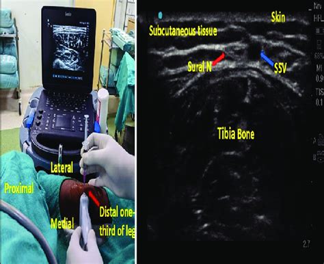 A Probe Position At The Middle And Lower Third Of The Posterior