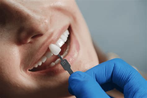 Essential Tips For Maintaining Porcelain Veneers