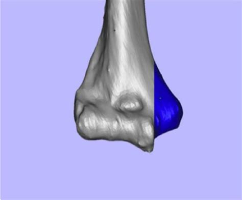 Lateral Epicondyle Of The Humerus