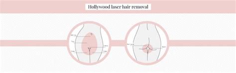 How Does Laser Hair Removal Work On The Bikini Line Urbana