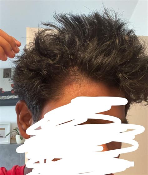 Am I Balding Or Is My Hairlines Thinning Rminoxidil