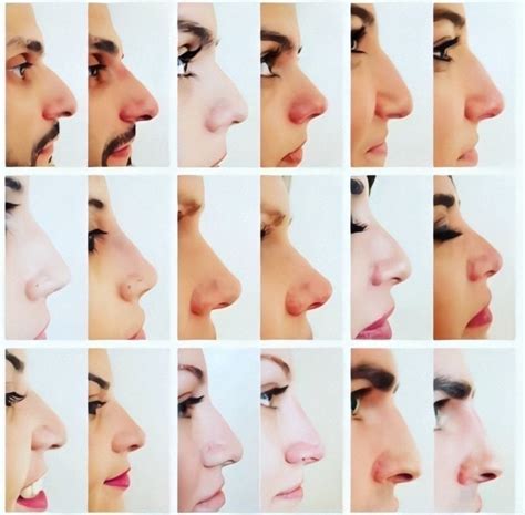 Best 14 Tipos De Nariz Artofit