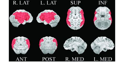Cortical Surface Map Of The Mca Territory Superimposed On Neurostat T Download Scientific