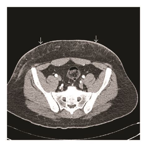 A CT Abdomen Coronal View Showing Inflamed Appendix Red Arrow Download Scientific