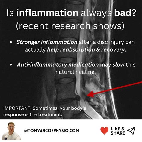 Tom New Research Zhao Et Al 2025 Highlights That In Lumbar Disc
