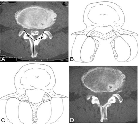 Surgical Outcomes Of Modified Lumbar Spinous Process Splitting