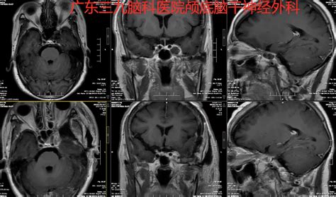 眼皮抬不起来了这又是什么病 肿瘤