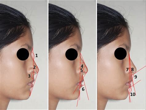 Photogrammetric Angular Measurements As A Diagnostic Tool For
