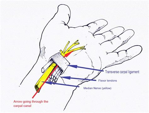 Carpal Tunnel Syndrome