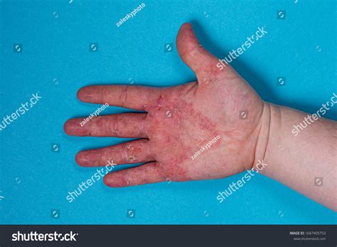 27 Cutaneous Toxicity Royalty Free Photos And Stock Images Shutterstock