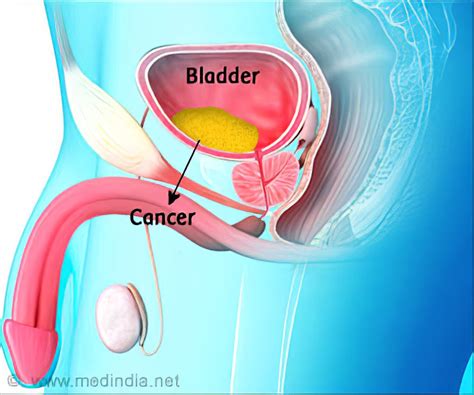 Bladder Cancer Cells