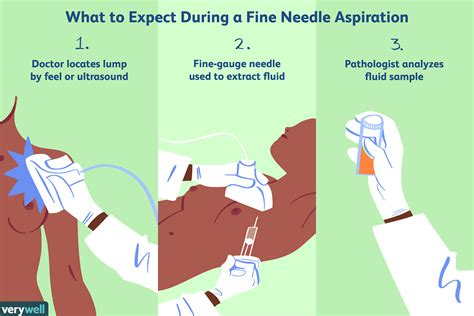 Fine Needle Aspiration For Breast Biopsy Procedure Side Effects